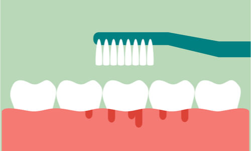 What Are The Things To Do If My Gums Bleed As I Brush Teeth?