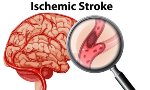 Complications After Stroke: How To Keep It Under Control?